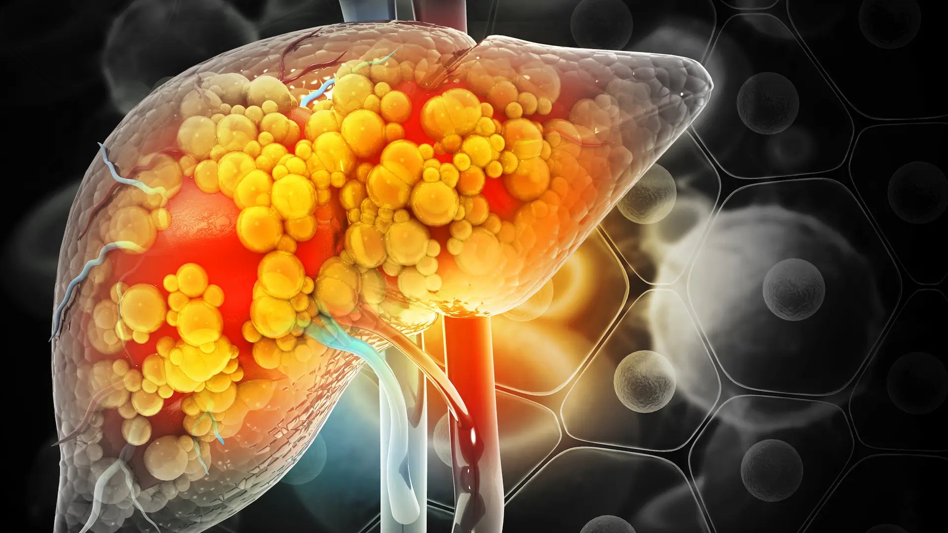 Alpha-1 antitrypsin deficiency (AATD) - Medthority