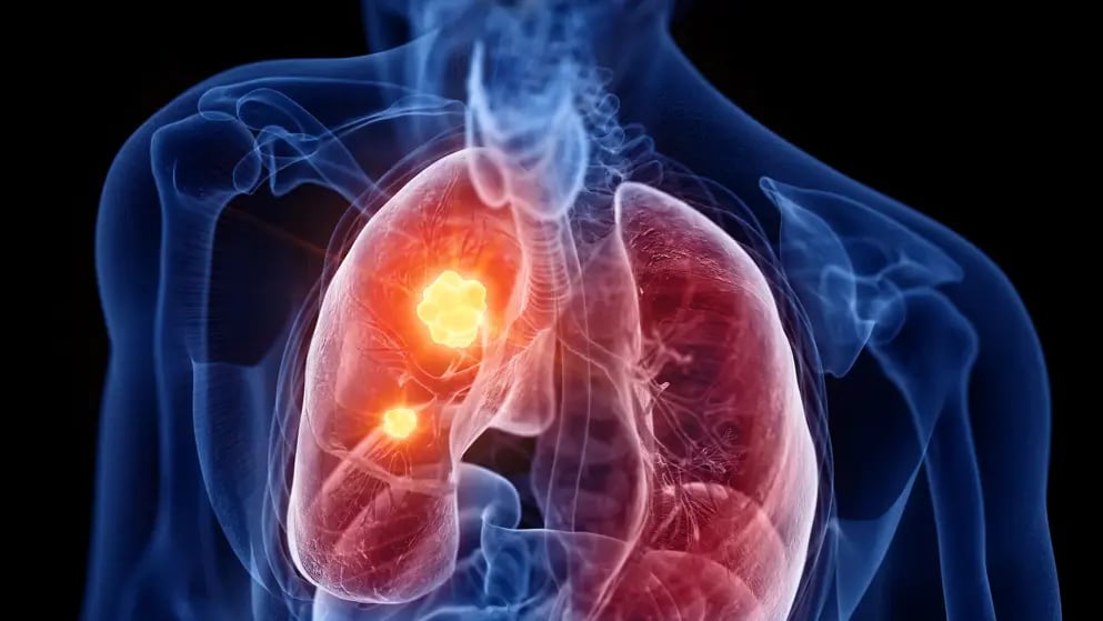 Non-small Cell Lung Cancer - Medthority