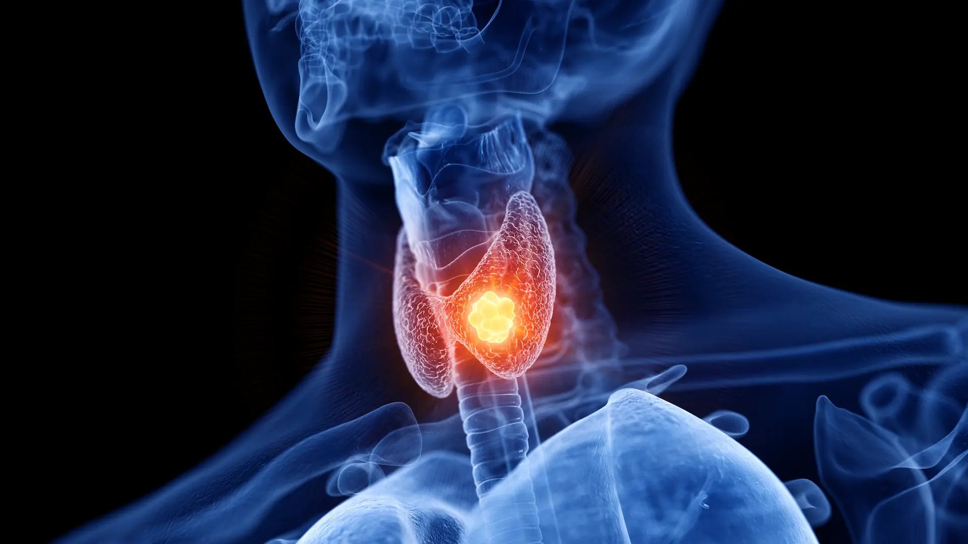Thyroid Cancer - Medthority