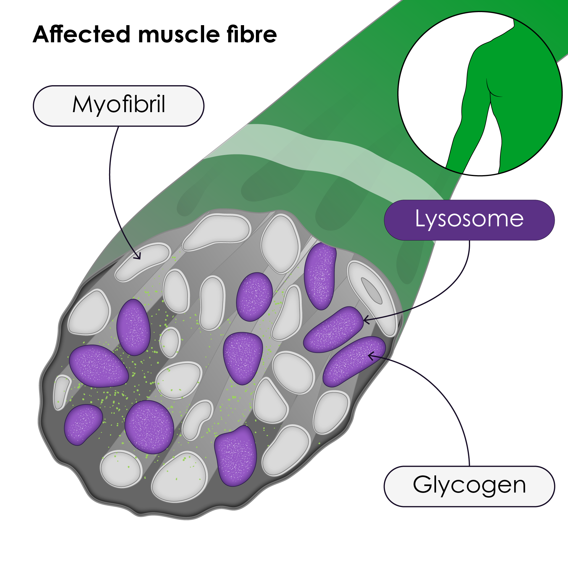 Congress highlights | Pompe Disease: Key findings from WMS 2022 ...