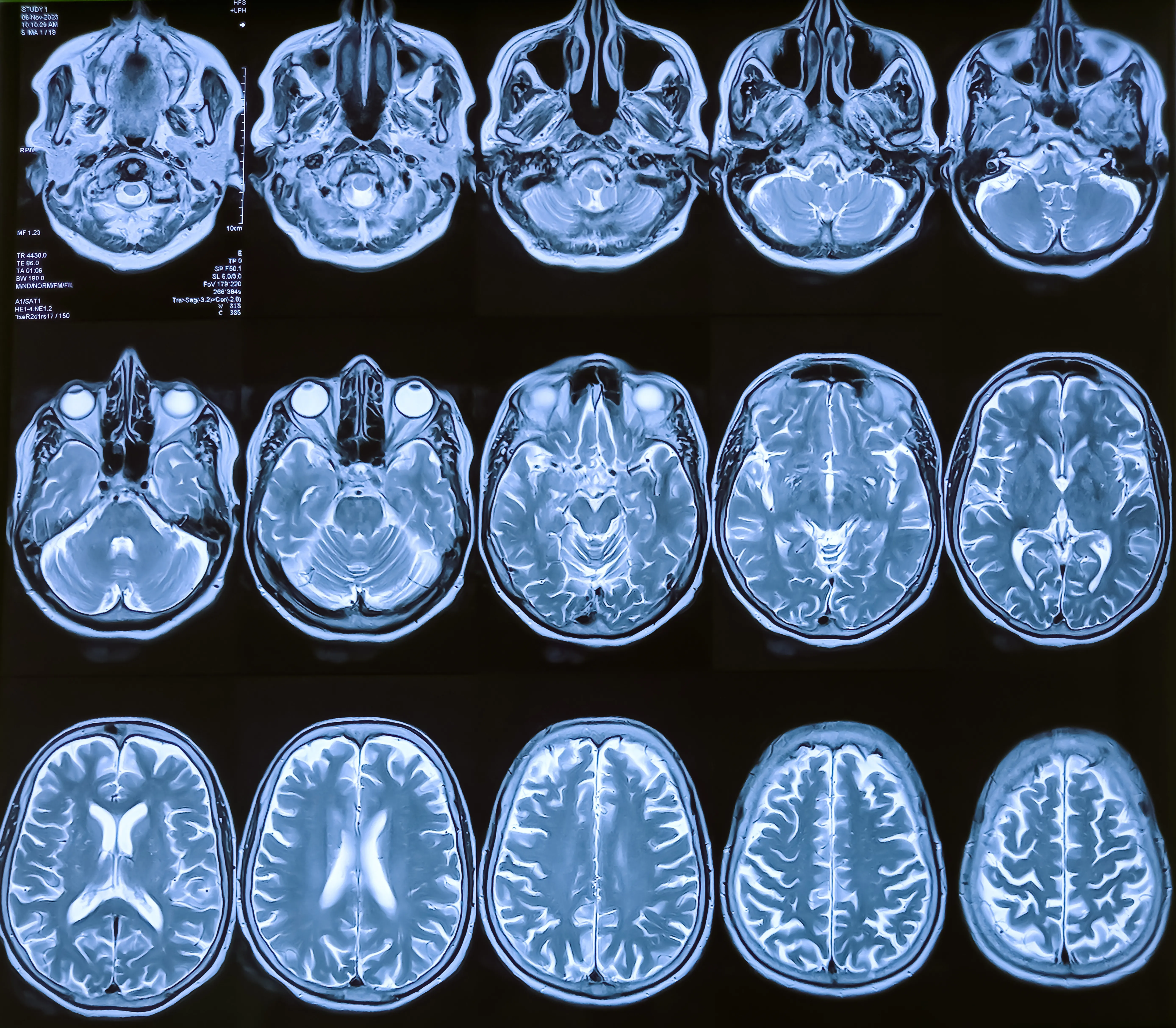 RMS ECTRIMS 2025 ePosters - Medthority