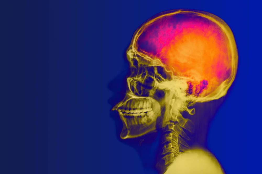 Anticoagulation Guidelines Anticoagulation Therapy For Stroke Anticoagulation Guidelines Anticoagulation Therapy For Stroke