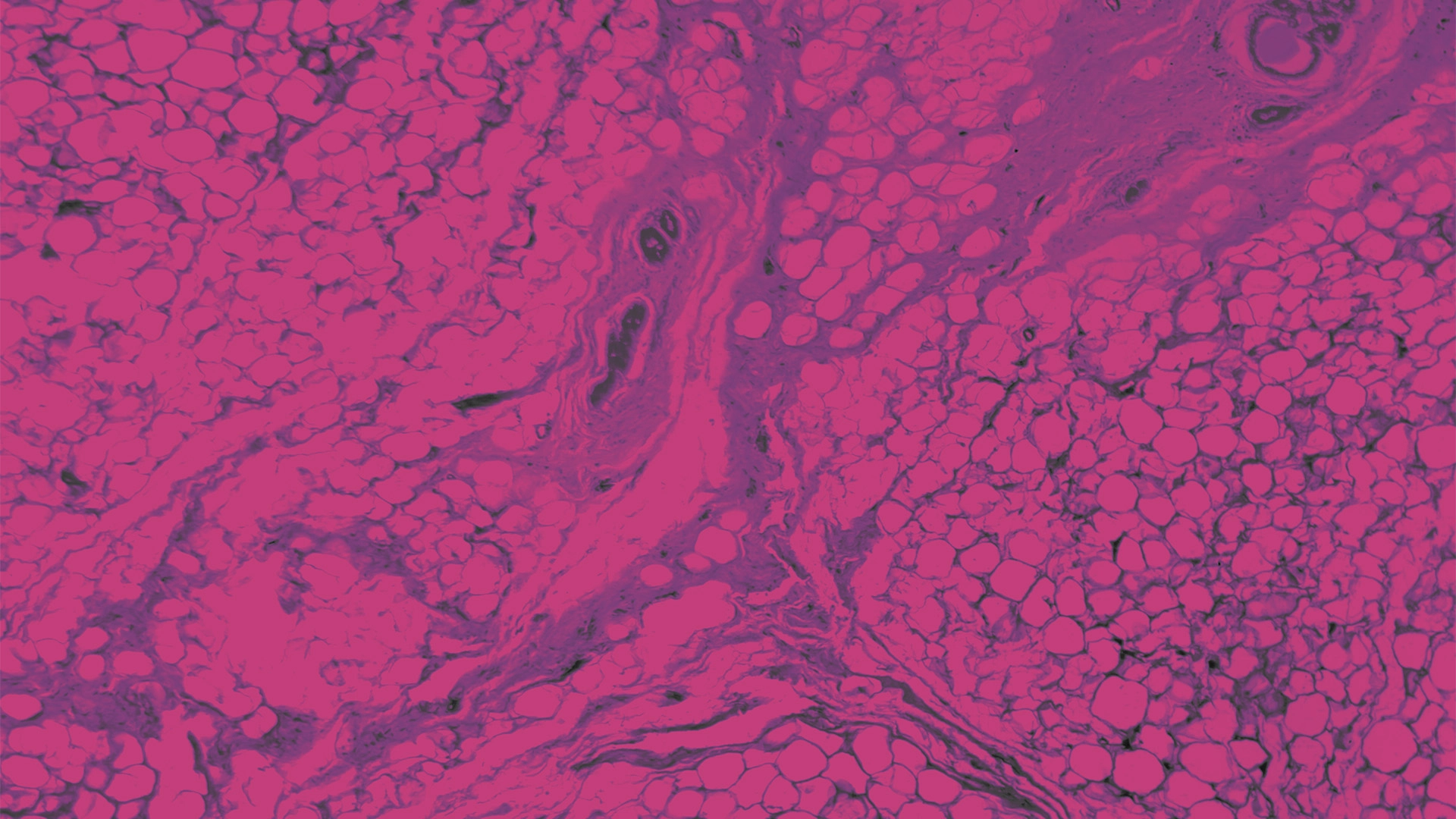 ESMO Breast Cancer 2022: Day 2 highlights - Medthority