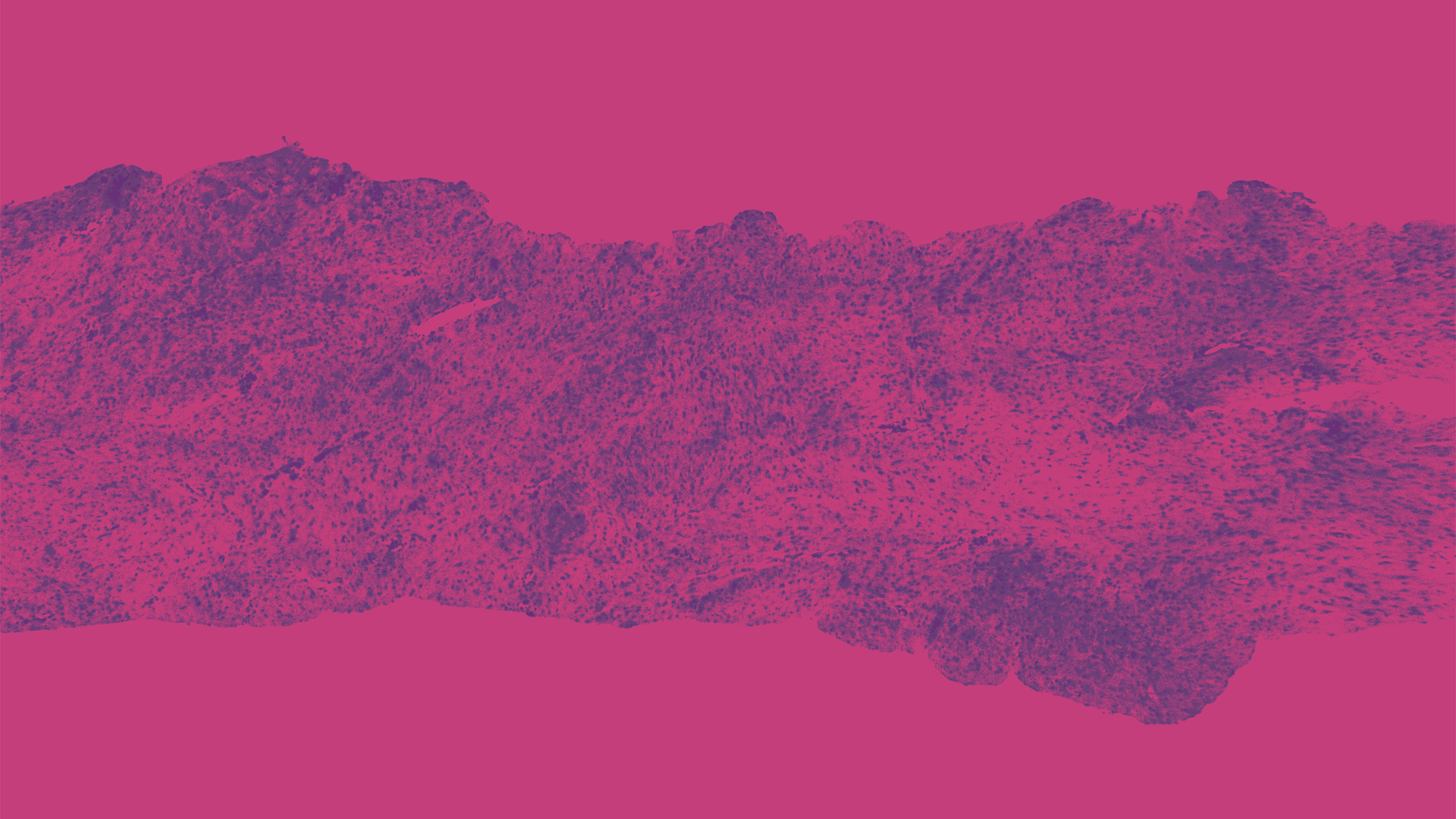 DGHO 2025: Desmoid tumors expert insights - Medthority